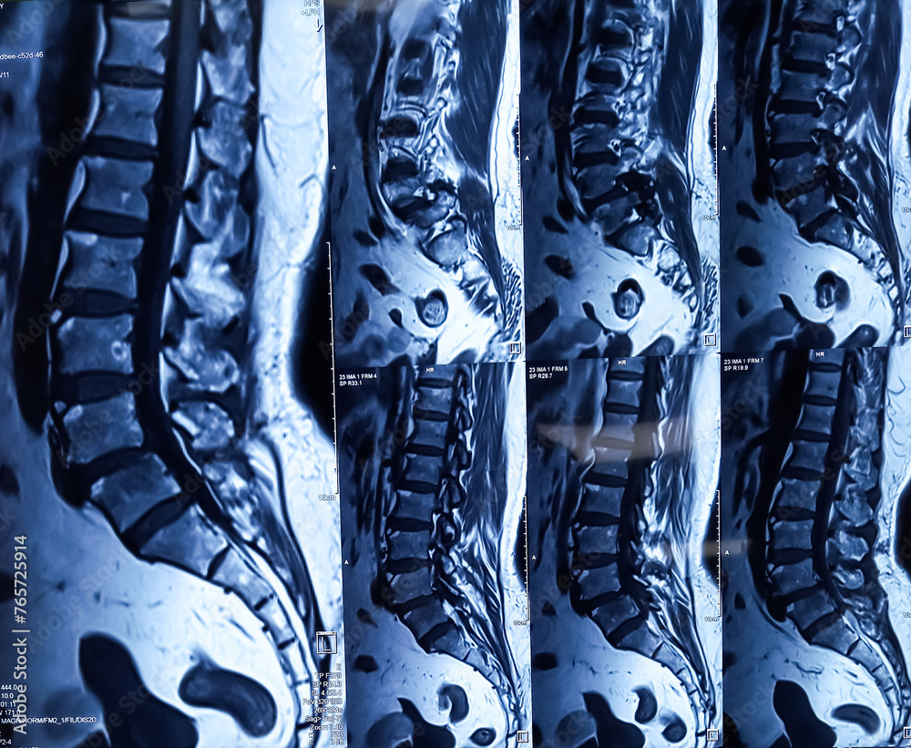 MRI scan of sacro-lumbar spines of a patient with chronic back pain and ...