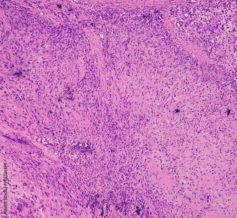 Bone cancer. Chondroblastic osteosarcoma. It's very rare cancer ...