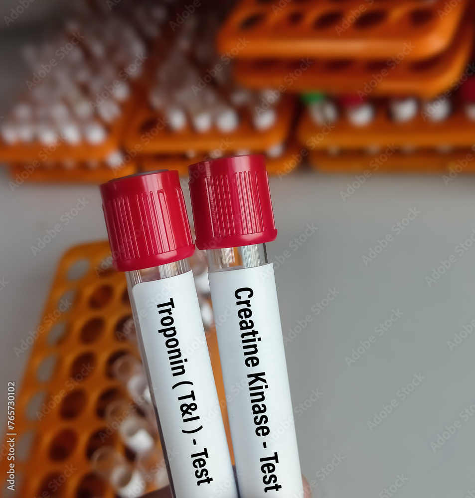 Blood sample for Troponin and Creatine kinase test to diagnosis of ...
