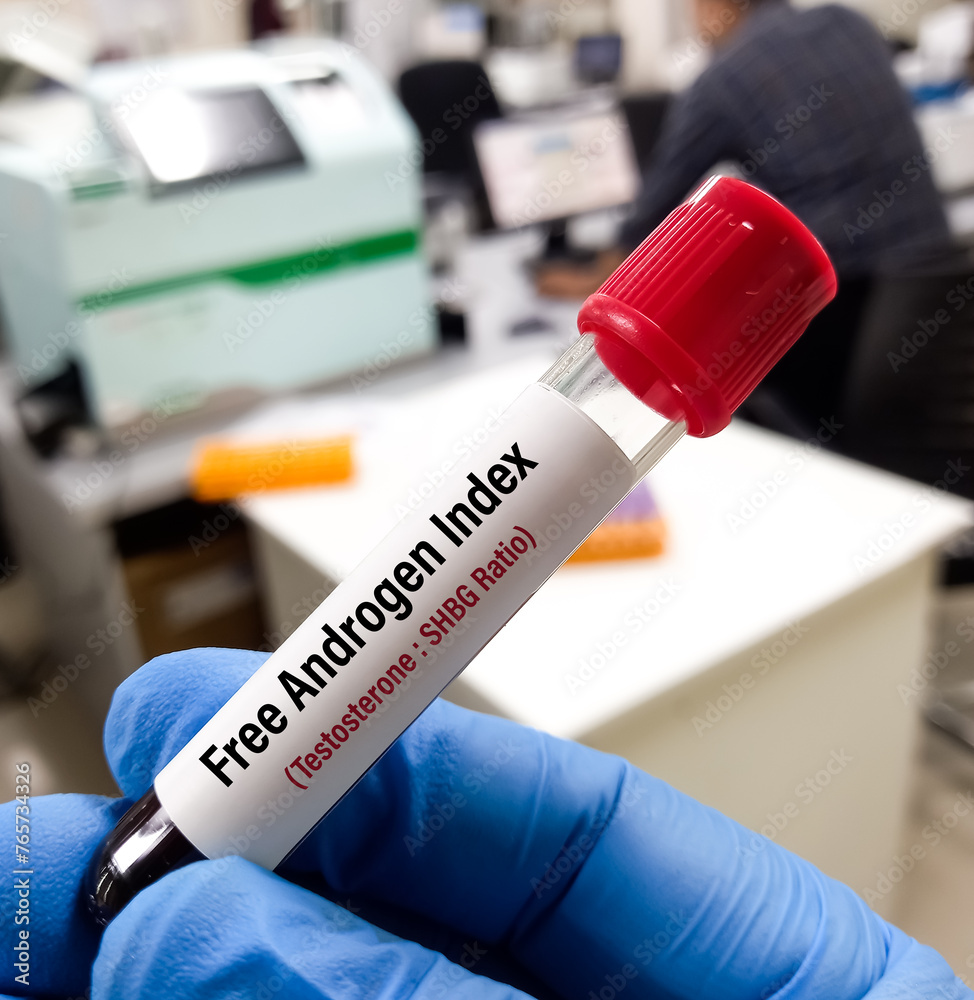 Blood sample for Free Androgen Index (FAI) test, It's used to determine ...