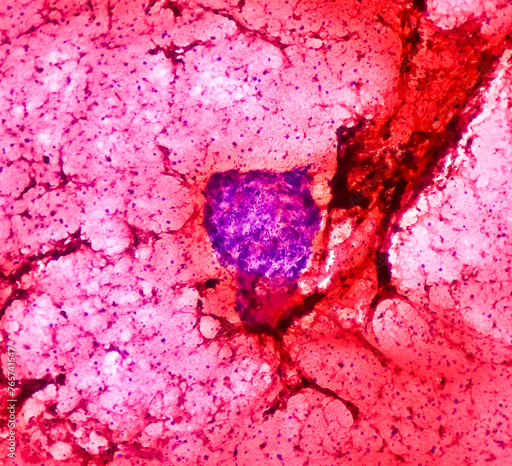 Photomicrograph of Osteolytic lesion of left proximal radium, Positive ...