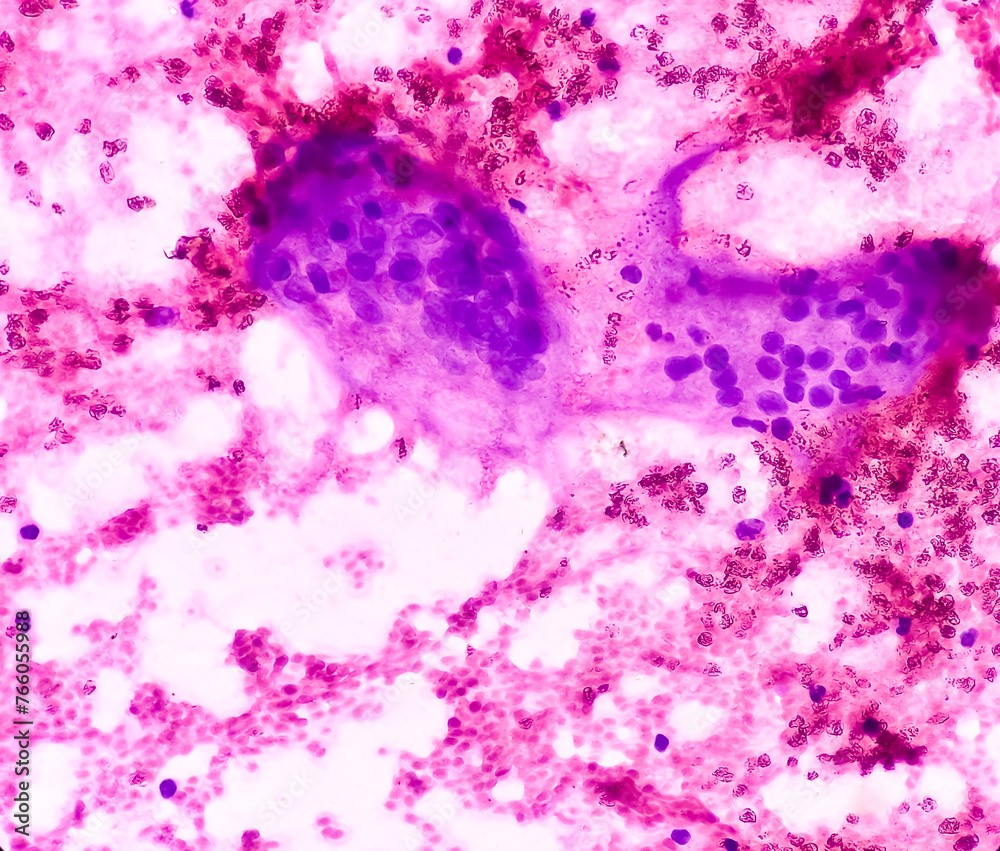 Photomicrograph of Chronic granulomatous inflammation (CGI) with ...