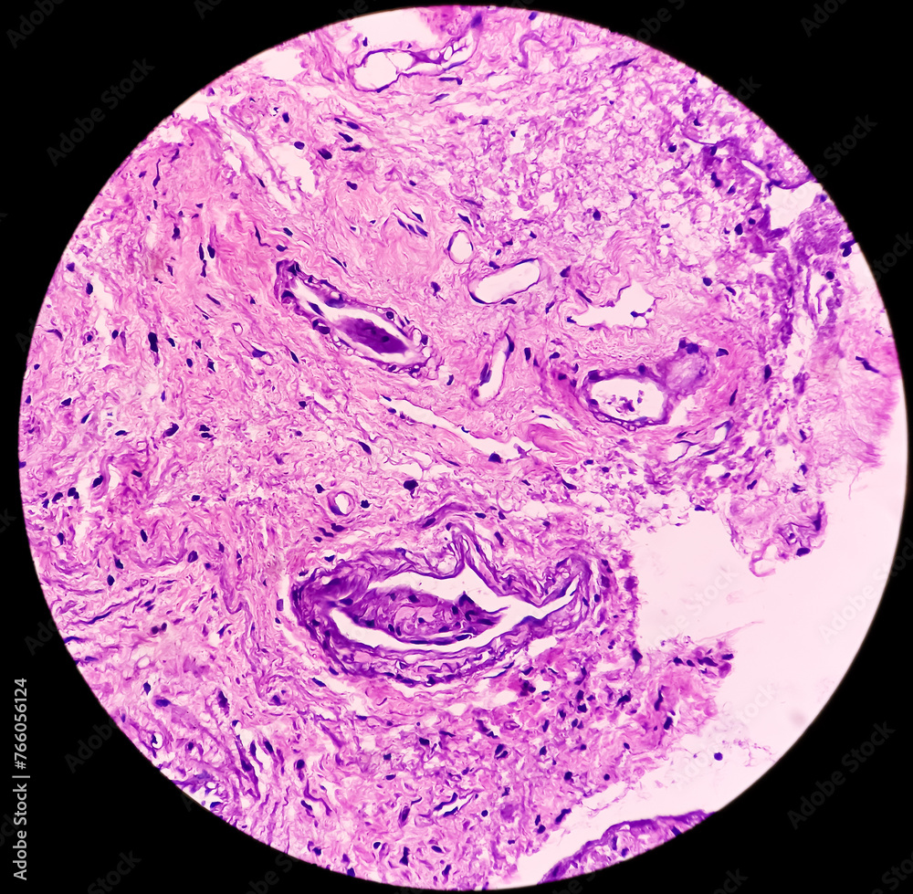 Urachal cyst or Urethral cyst (biopsy). Microscopically show cyst wall ...
