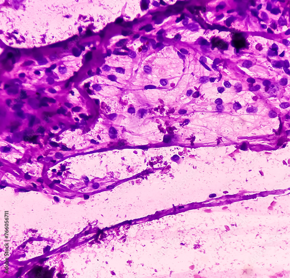 Swelling of leg (FNA cytology). Synovitis. smear show polymorphs ...