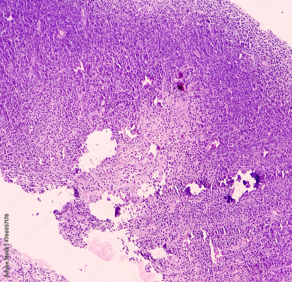 Soft tissue sarcoma, plasmacytoma, undifferentiated pleomorphic sarcoma ...