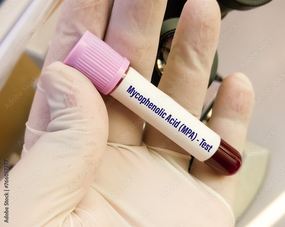 Blood sample for Mycophenolic Acid (MPA) test, to monitor therapeutic ...