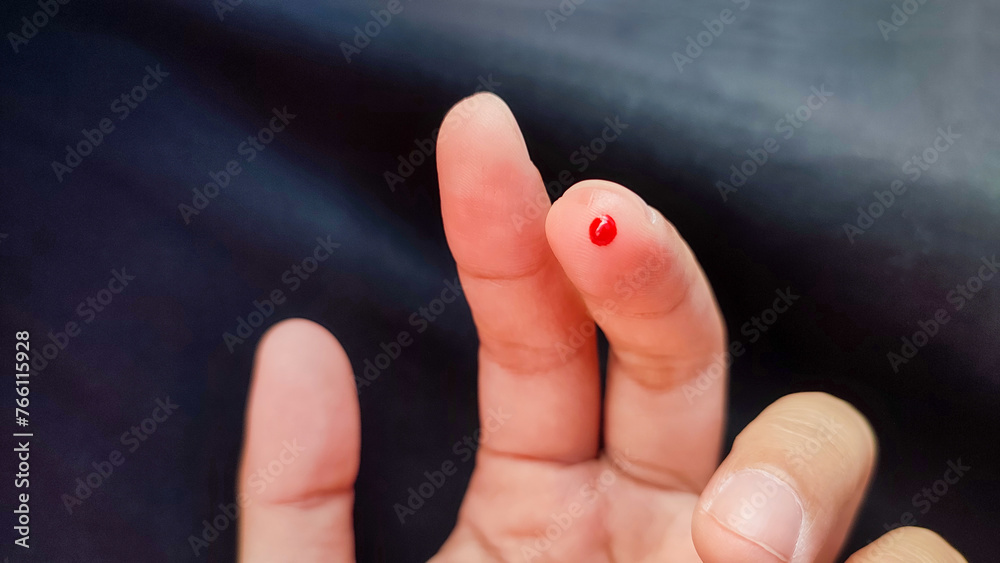 A drop of blood on the fingertip due to a needle prick to check uric ...