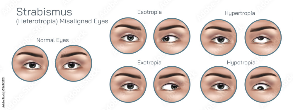 In a person with strabismus, the eyes may not align properly, This ...