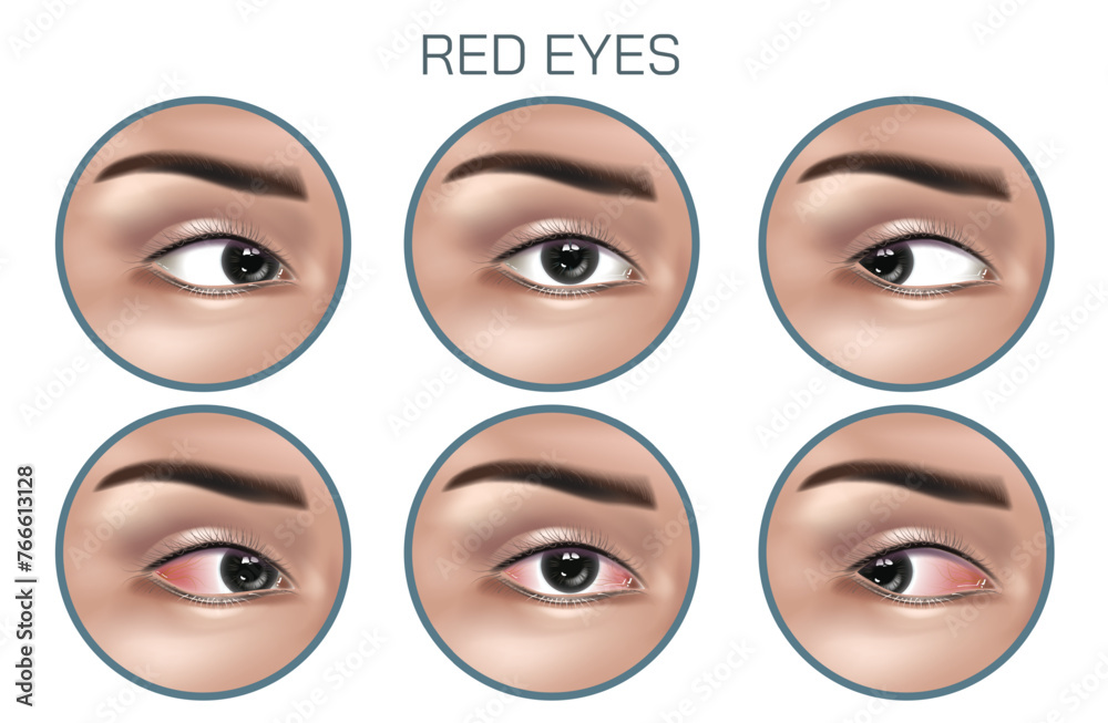 Inflammation of the conjunctiva, the thin, transparent membrane ...
