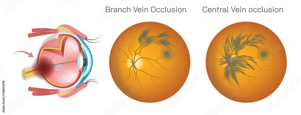Branch or Central retinal vein occlusion is a serious eye condition ...