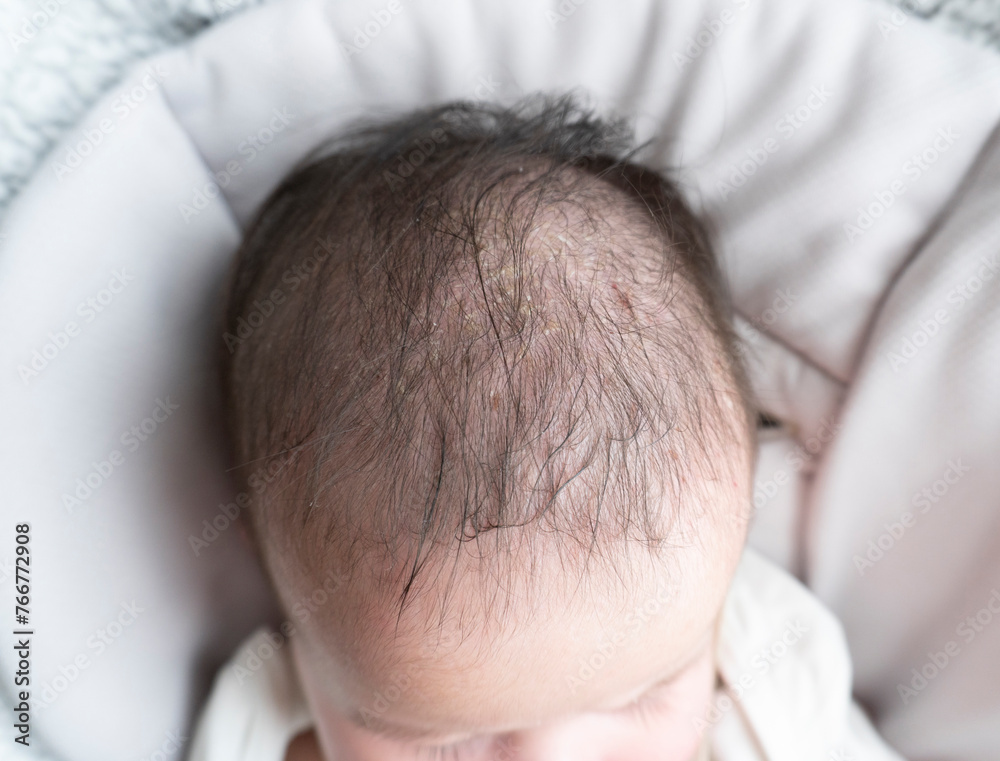 Seborrheic dermatitis crusts on the baby's head. Child with seborrhea ...
