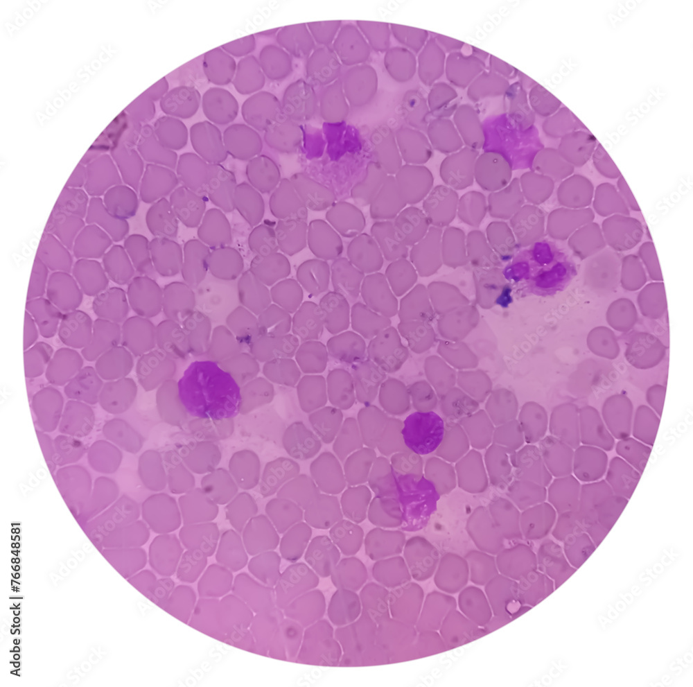 Bone marrow study (BMD). Myelodisplastic syndrome (MDS) or Refractory ...