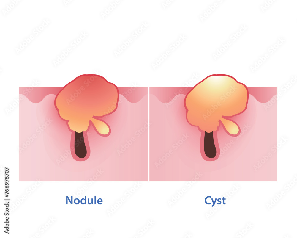 The difference between nodule and cyst vector on white background ...