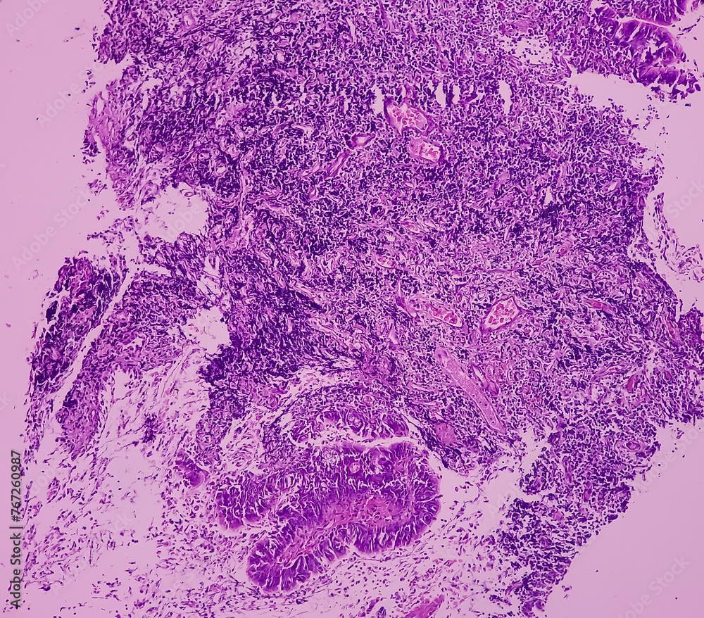 Olfactory neuroblastoma and Non-Hodgkin's lymphoma. Smear show ...