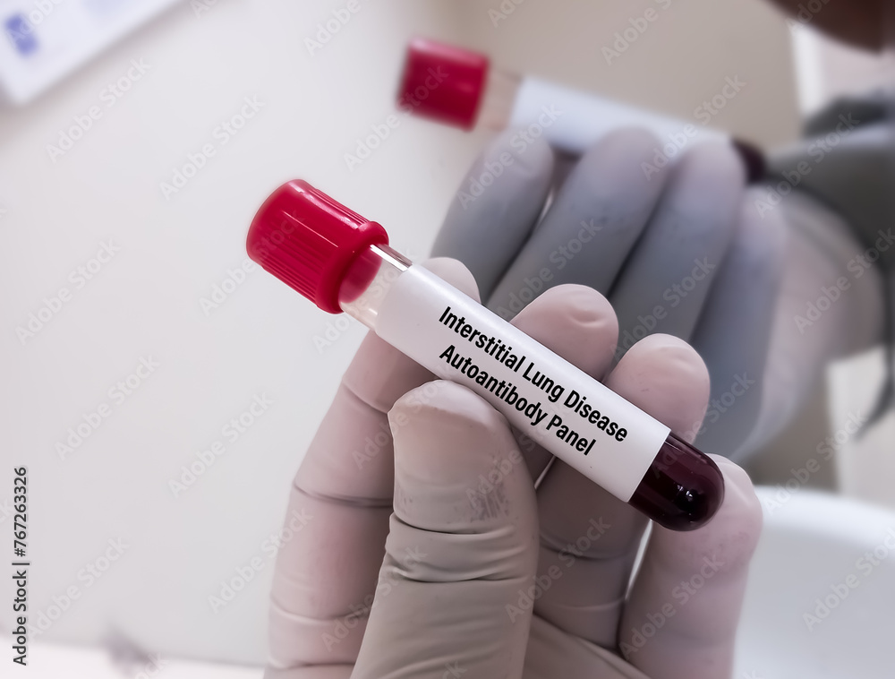 Technologist holds blood sample for Interstitial Lung Disease ...