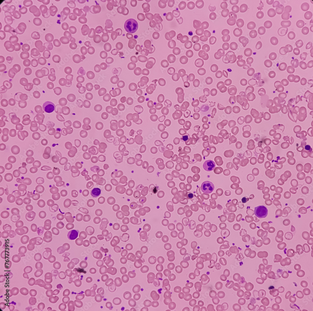 Fotka „Blood smear, Hereditary hemolytic anemia. Hemoglobin E (HbE ...