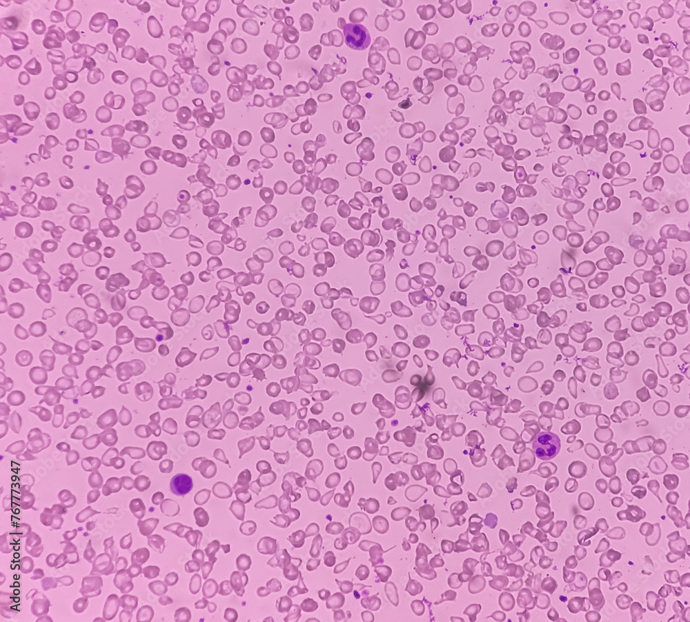 Blood smear, Hereditary hemolytic anemia. Hemoglobin E (HbE) disease ...