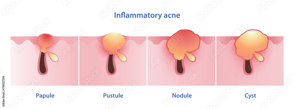 Diagram Of Inflammatory Acne Types Vector Illustration Isolated On