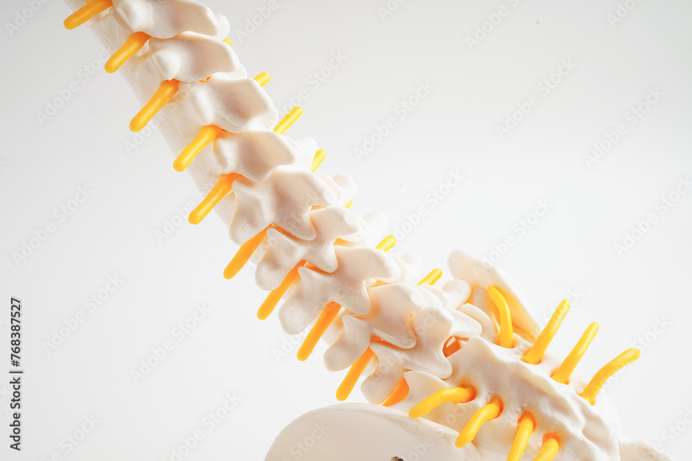 Spinal nerve and bone, Lumbar spine displaced herniated disc fragment ...