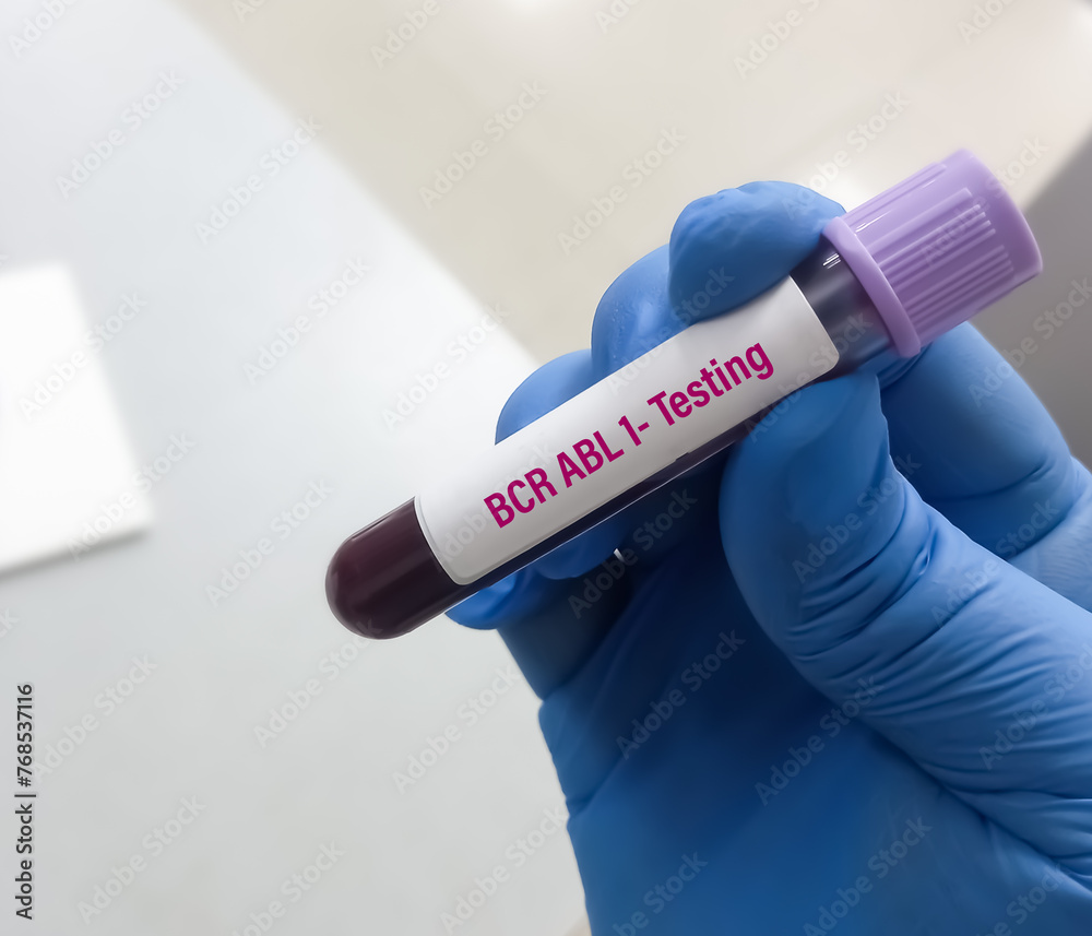 BCR-ABL 1 test is used to diagnose CML, a type of leukemia. BCR ABL ...