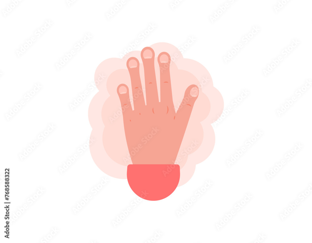 clubbing fingers. illustration of a hand with swollen fingertips ...