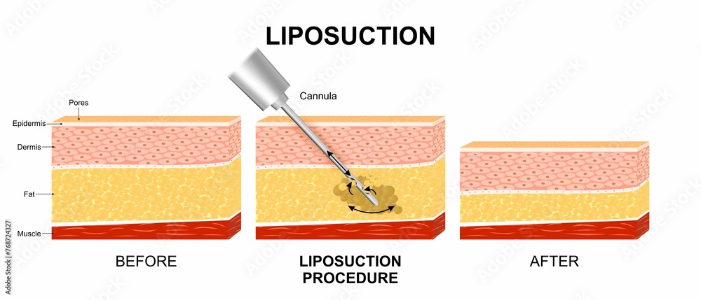 The process of Lipedema of the fat in the skin of a female patient in ...