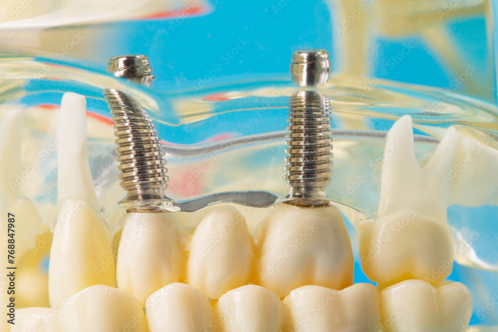 Medical model of a patient's dental jaw with pins in the gums and ...