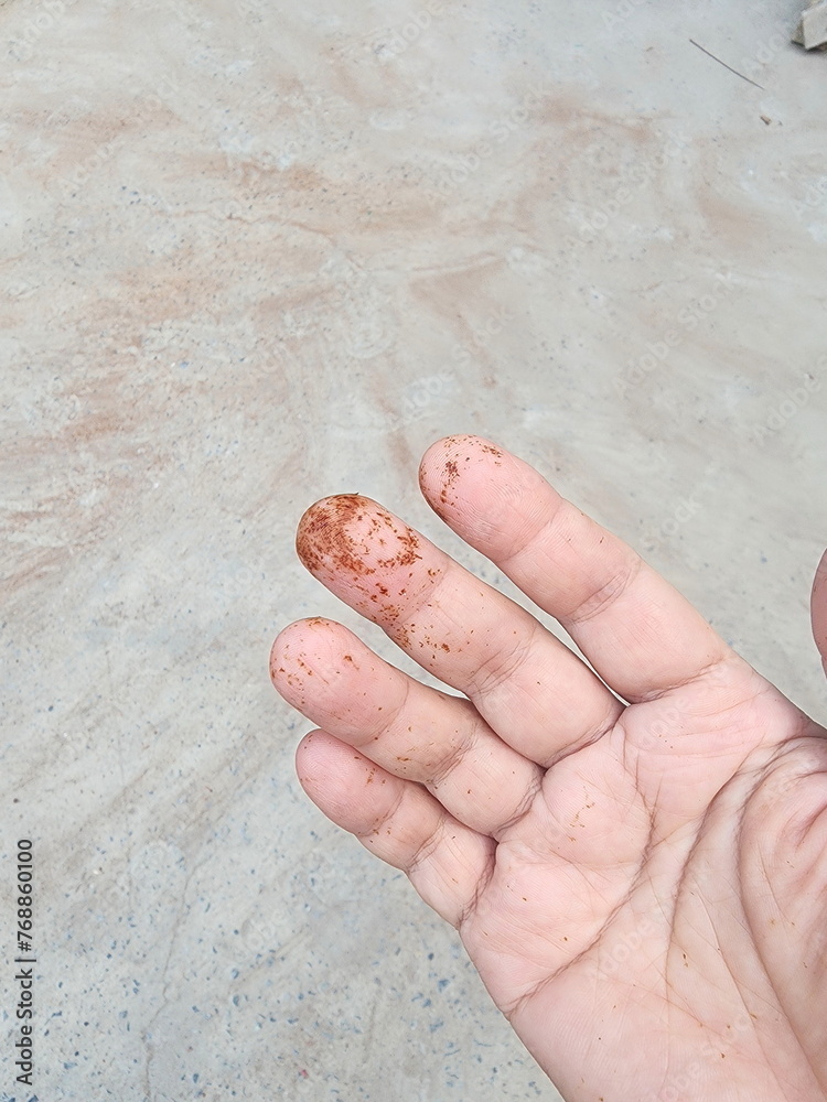 Brown stains on fingers are caused by scales of potassium permanganate ...