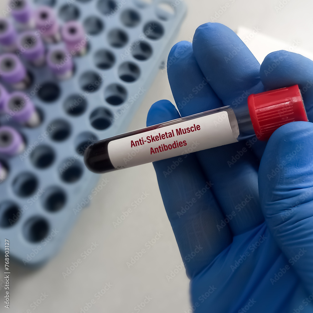 Blood sample for Skeletal (Striated) Muscle Antibody (ASKA) Testing ...