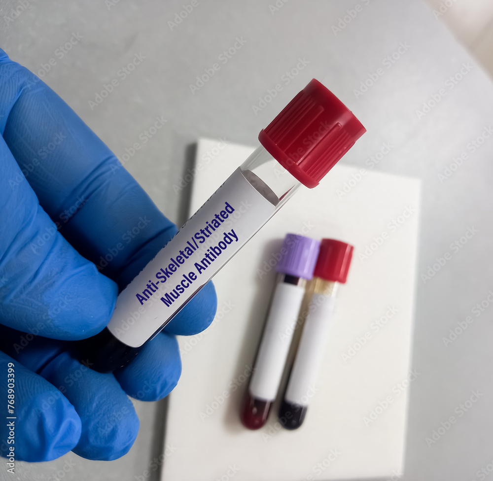 Blood sample for Skeletal (Striated) Muscle Antibody (ASKA) Testing ...