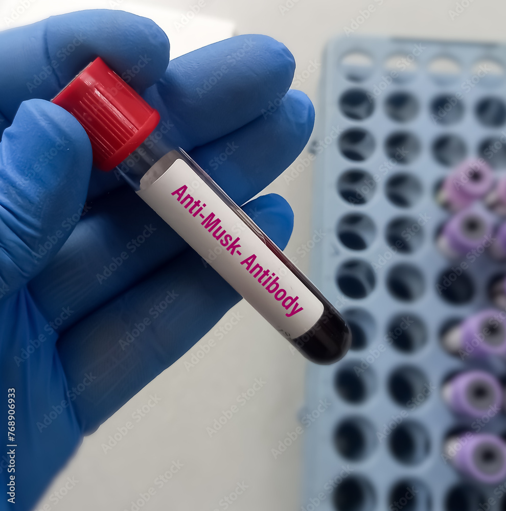 Blood sample for MuSK(muscle-specific kinase) protein test to diagnosis ...