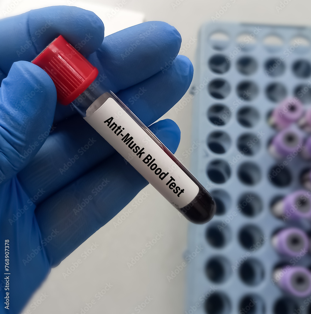 Blood sample for MuSK(muscle-specific kinase) protein test to diagnosis ...