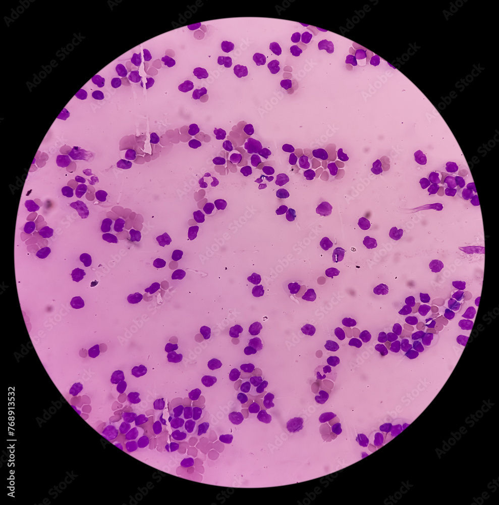 Lymphocytosis with Thrombocytopenia. Smear show white blood cells, red ...