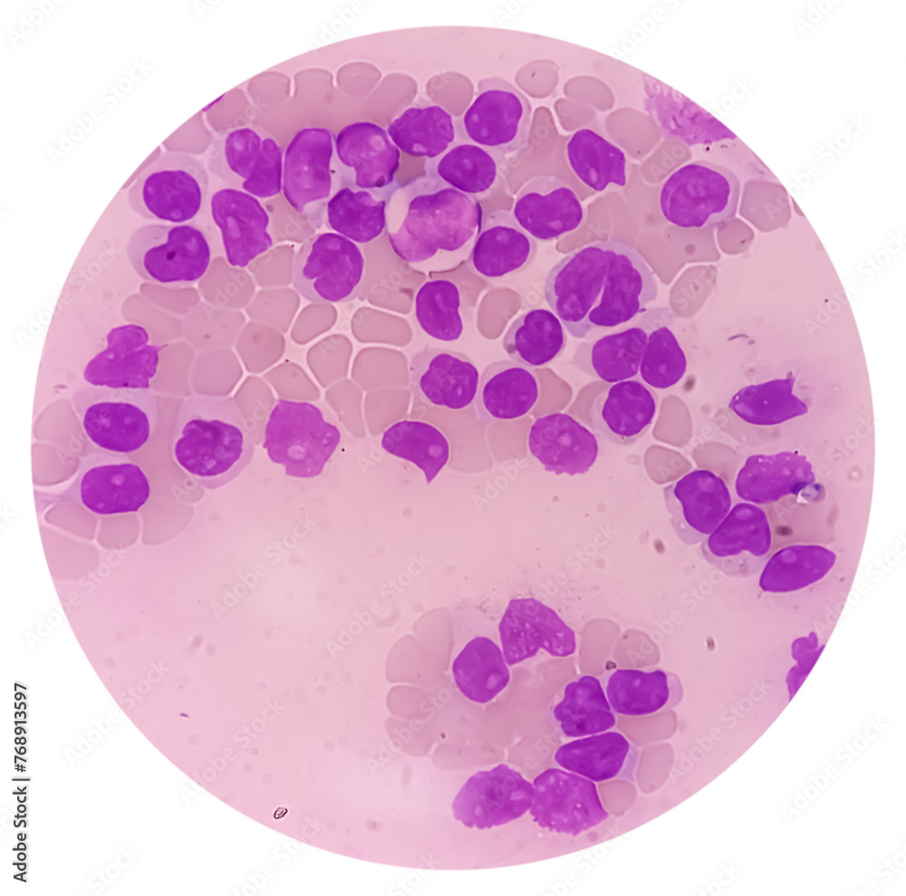Lymphocytosis with Thrombocytopenia. Smear show white blood cells, red ...
