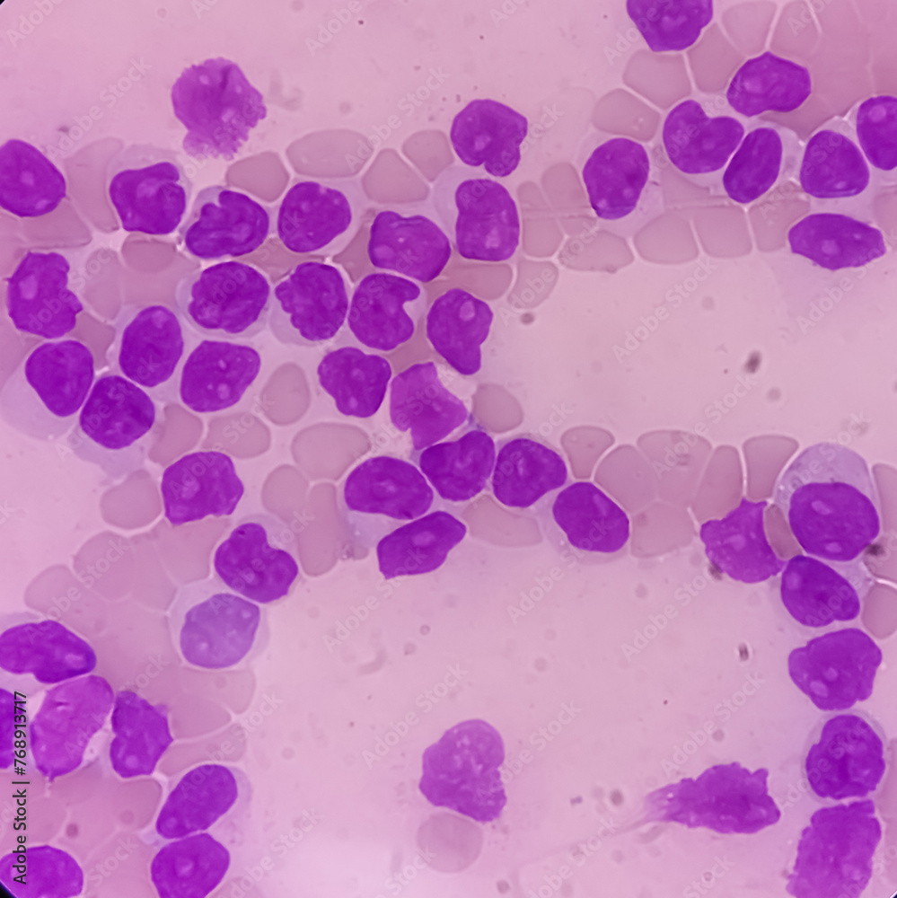 Lymphocytosis with Thrombocytopenia. Smear show white blood cells, red ...