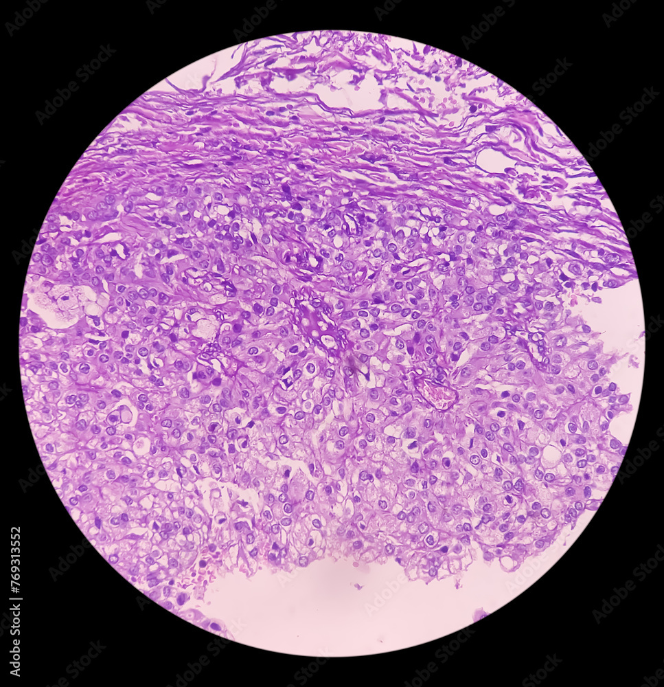 Kidney cancer: Clear cell carcinoma. fuhrman nuclear grade-II, Renal ...