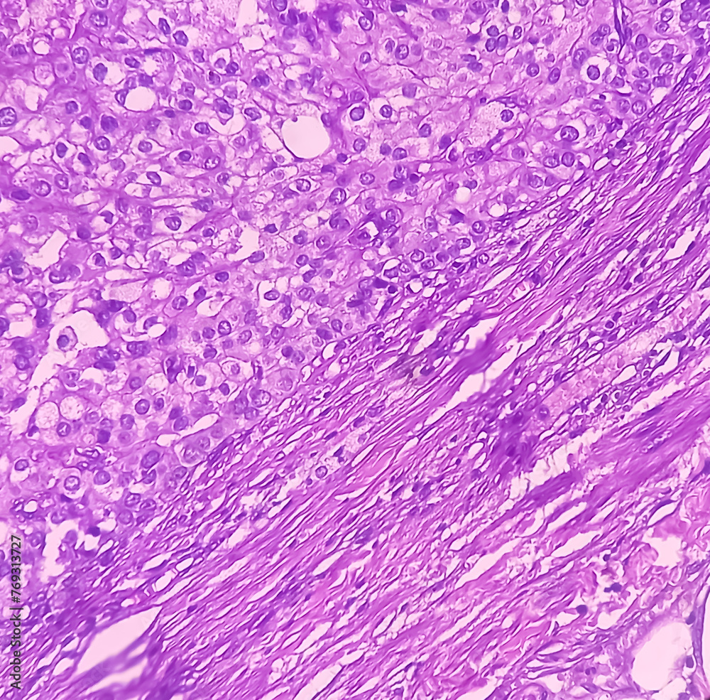 Kidney cancer: Clear cell carcinoma. fuhrman nuclear grade-II, Renal ...