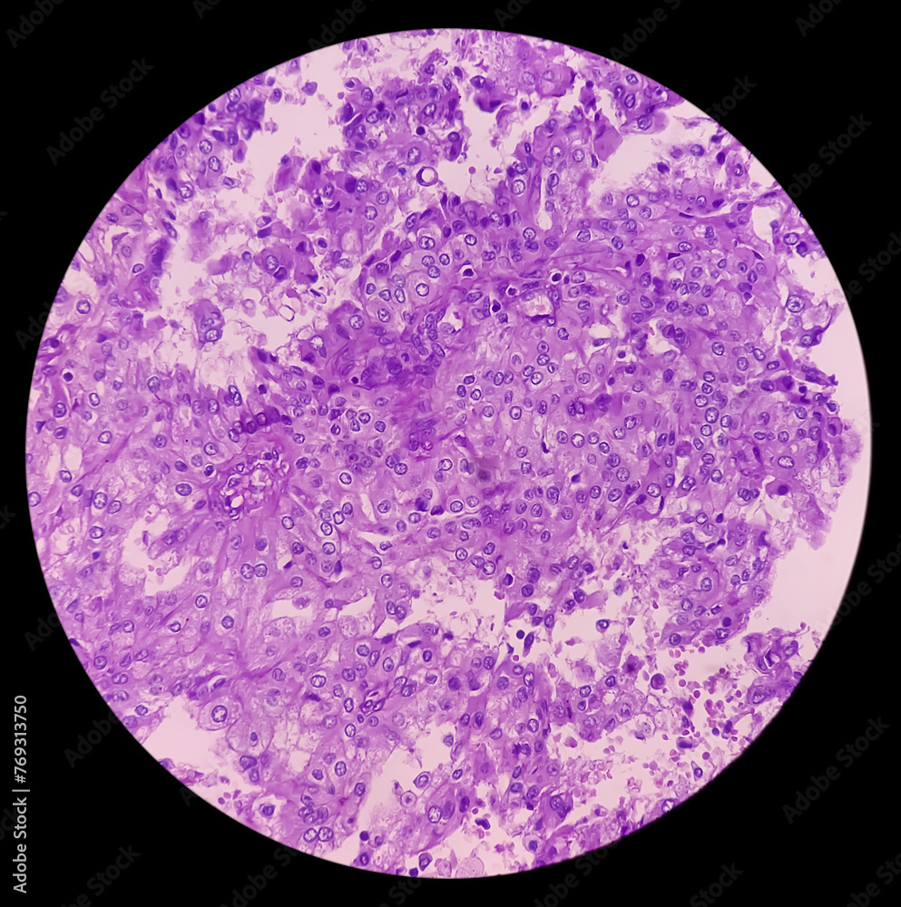 Kidney cancer: Clear cell carcinoma. fuhrman nuclear grade-II, Renal ...