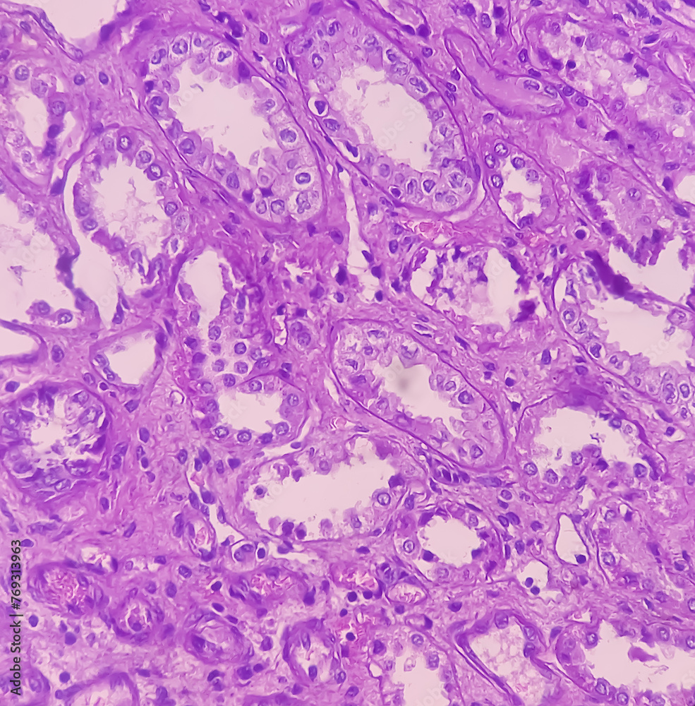 Kidney cancer: Clear cell carcinoma. fuhrman nuclear grade-II, Renal ...
