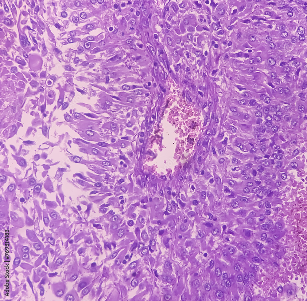 Kidney cancer: Clear cell carcinoma. fuhrman nuclear grade-II, Renal ...