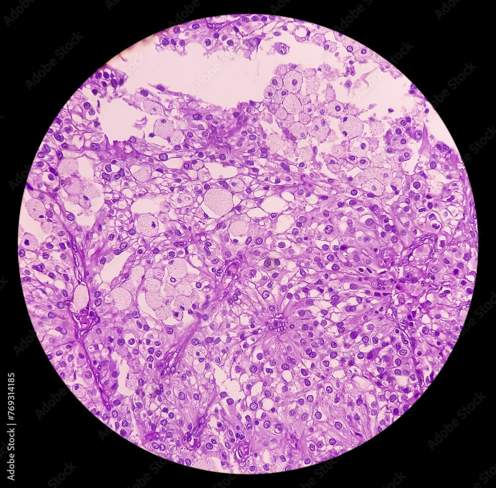 Kidney cancer: Clear cell carcinoma. fuhrman nuclear grade-II, Renal ...