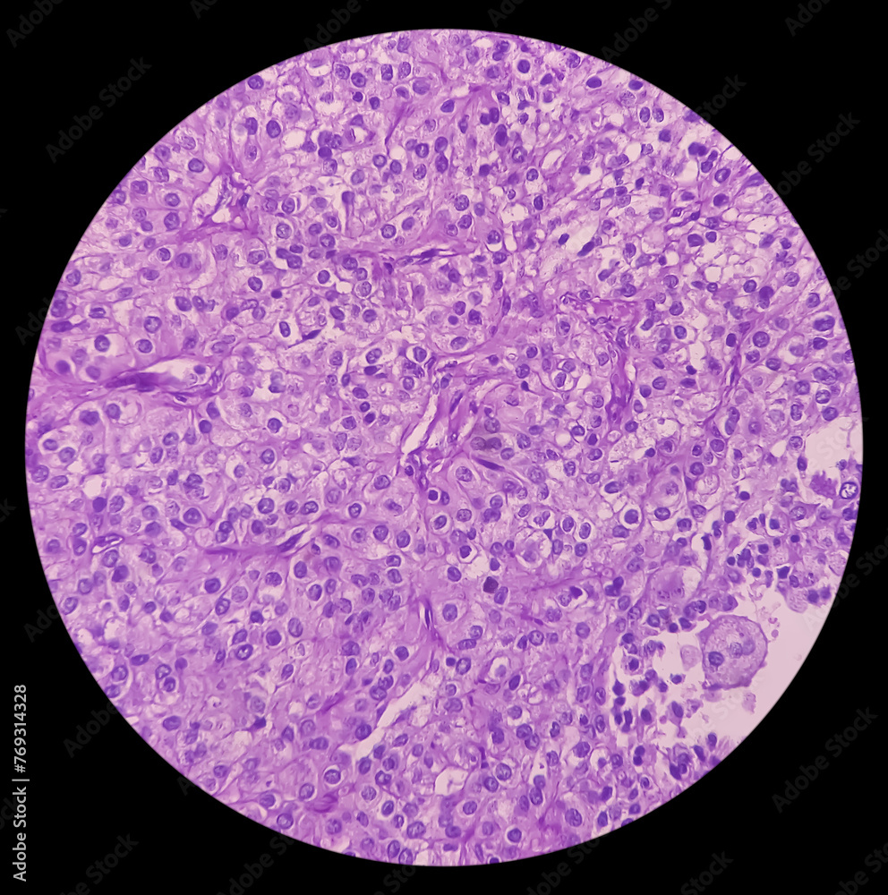 Kidney cancer: Clear cell carcinoma. fuhrman nuclear grade-II, Renal ...