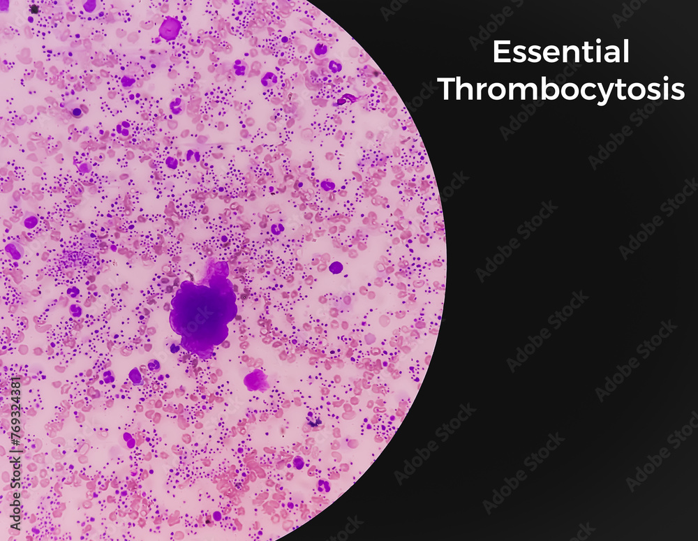 Essential thrombocytosis blood smear showing abnormal high volume of ...