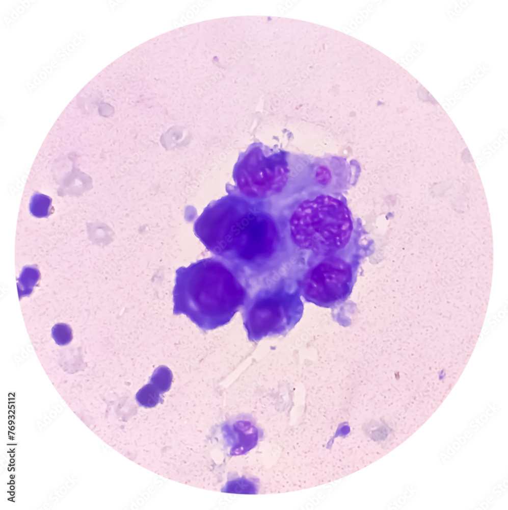Ascitic fluid cytology. Leishman stain smear show Lymphocytes ...