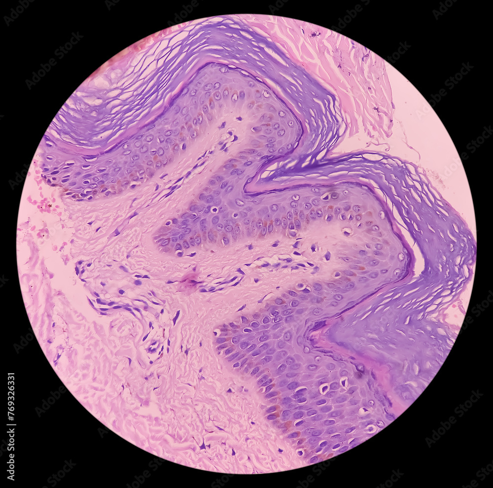 Hand skin tissue (biopsy) : Prurigo nodularis. Microscopically show ...
