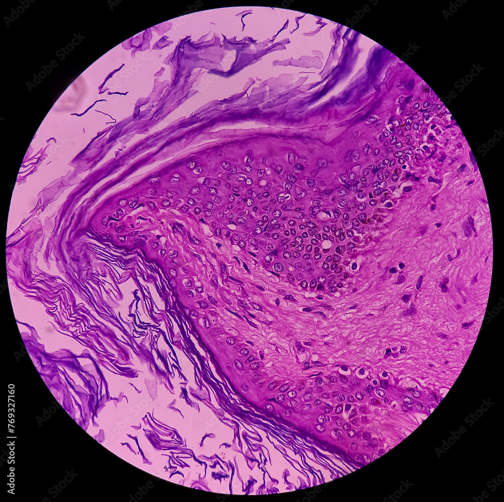 Mature cystic teratoma, Ovarian cyst biopsy, show cyst wall of skin and ...