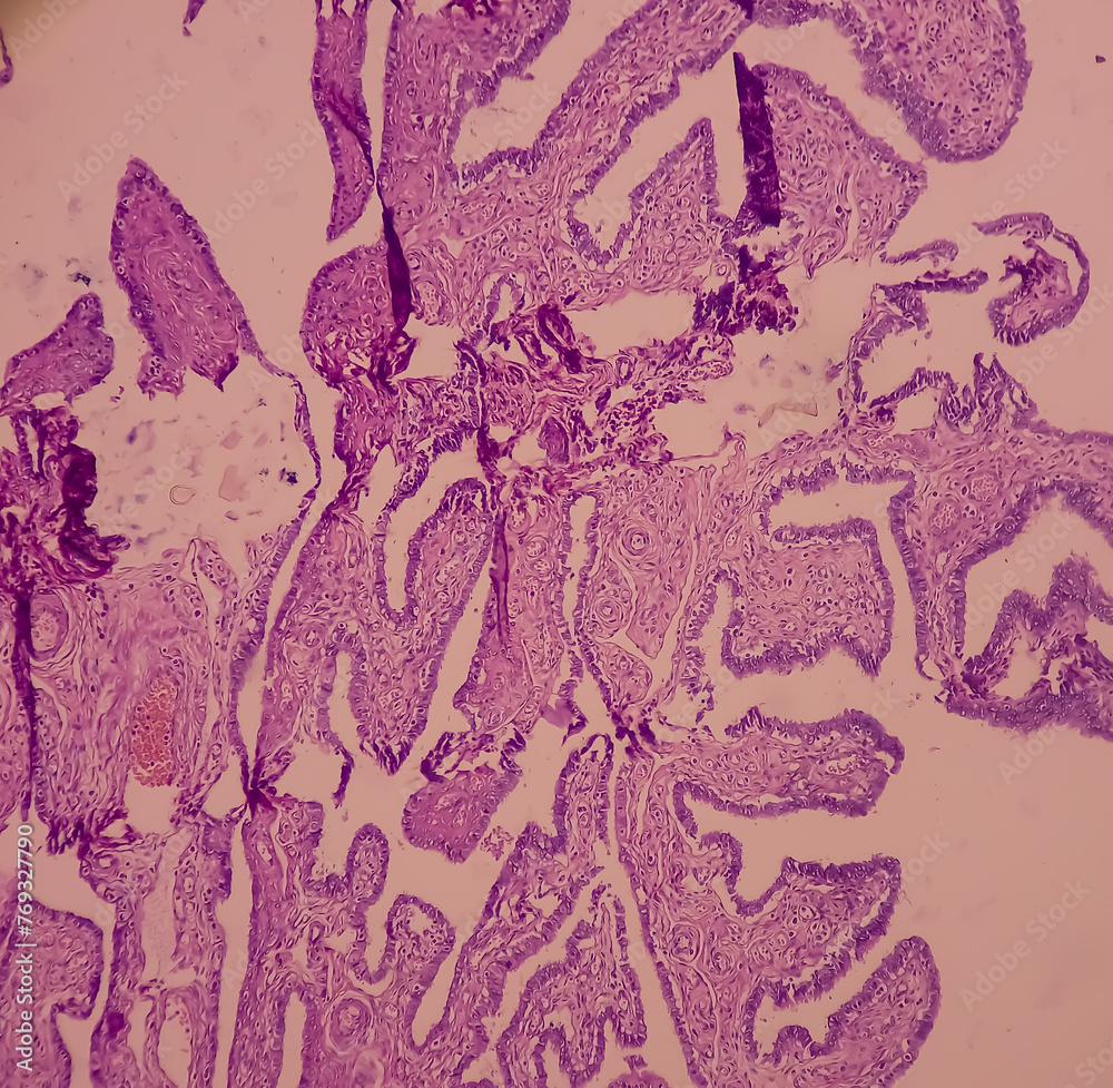 Mature cystic teratoma, Ovarian cyst biopsy, show cyst wall of skin and ...