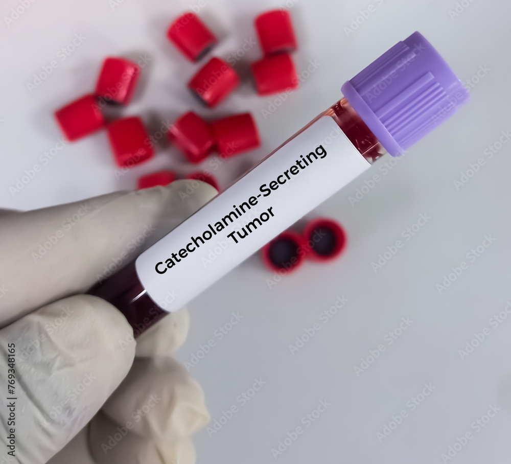 Blood sample for Clonidine Suppression test to diagnosis of ...