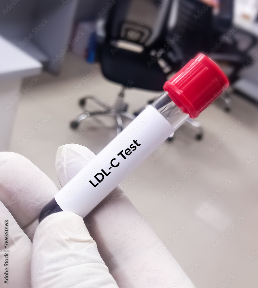 Blood sample for LDL-C (Low density lipoprotein cholesterol) test ...