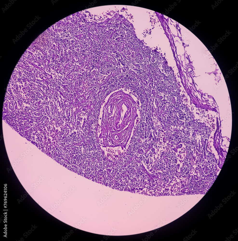 Foto de Microscopic image of above knee amputation. Section show fibro ...